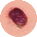 Sinais e Sintomas • Instituto Melanoma Brasil